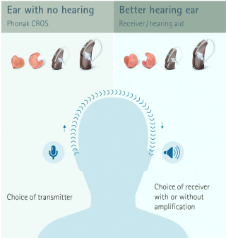 Do you have a Phonak Paradise CROS system? | Audiology South